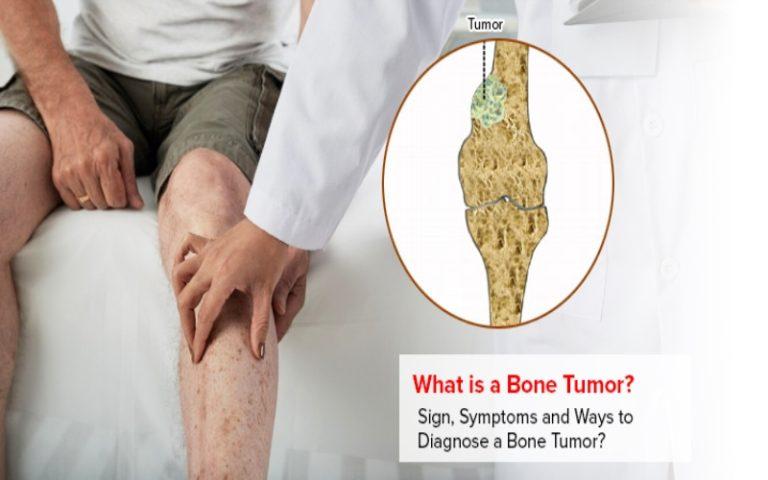 What is a Bone Tumor? Sign, Symptoms and Ways to Diagnose - Filmik
