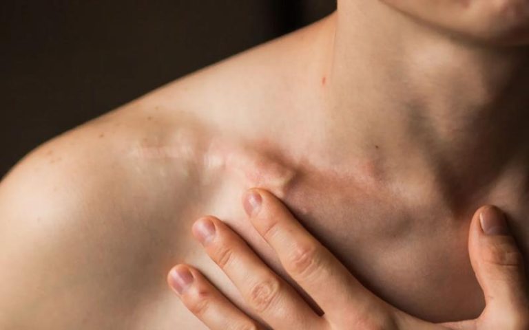 Acromioclavicular Joint Reconstruction in Singapore: A Guide to ...